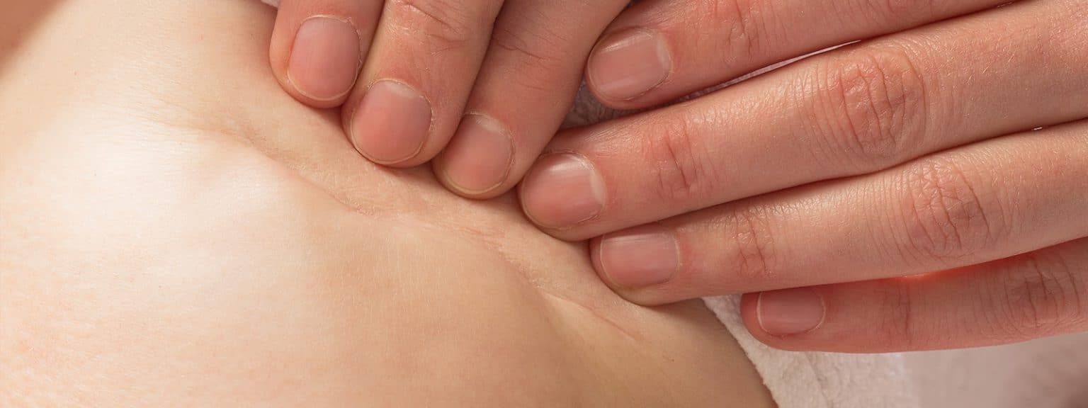 Littekens - DermaFlow Huidtherapie | Paramedische zorg Duiven